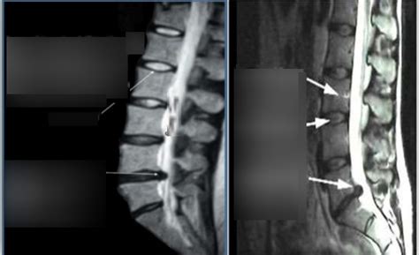 Lateral Lumbar Mri Myelogram Diagram Quizlet