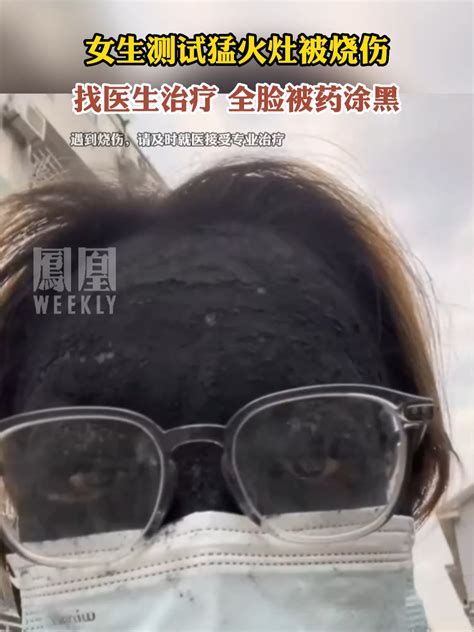 女生测试猛火灶被烧伤，找医生治疗全脸被药涂黑凤凰网视频凤凰网