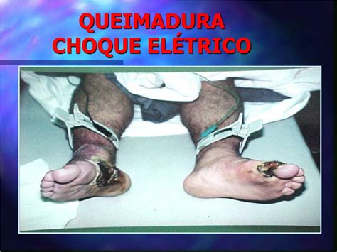 Lesão Por Choque Elétrico Librain