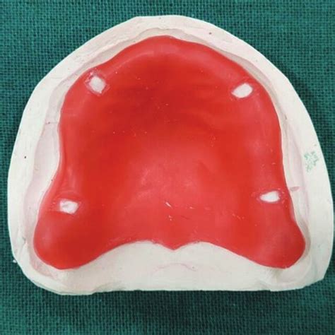 Primary Cast With Spacer Adapted Figure 6 Border Molded Upper Custom