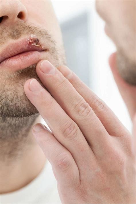 What Is The Difference Between Angular Cheilitis And Herpes 54 Off