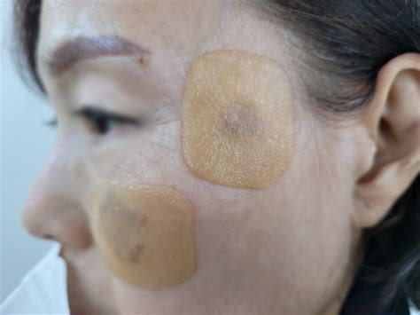 리팟레이저 얼굴 흑자 검버섯제거 내돈내산 후기가격 비용 네이버 블로그