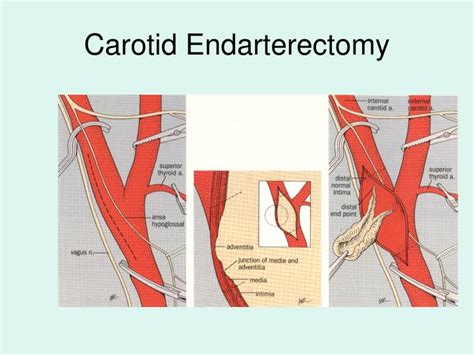 Ppt Surgical Intervention For Carotid Artery Disease Powerpoint Presentation Id416629