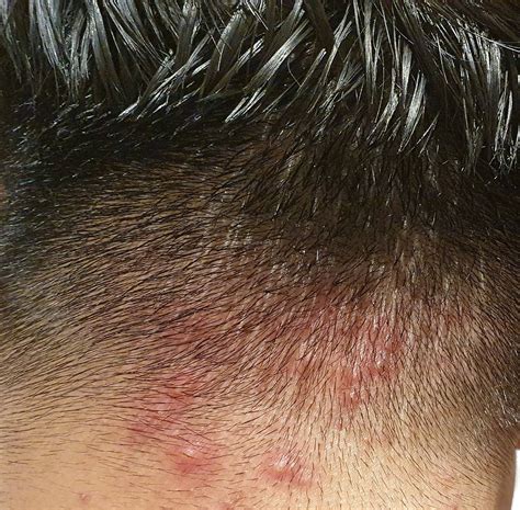 Did Accutane Help With Scalp Folliculitis R Folliculitis
