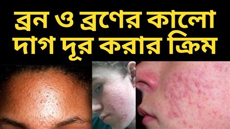 ব্রন ও ব্রণের কালো দাগ দূর করার ক্রিম Benoxiclin Gel Clindamycin 1