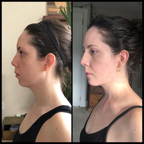 Before And After Sliding Genioplasty Submental Lipo And Fat Grafting