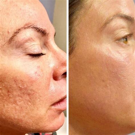 Microneedling Collagen Induction Microneedling For Skin Collagen Azpmu
