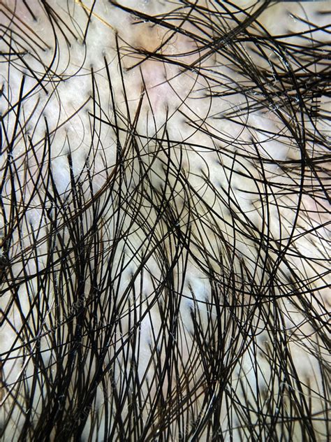 Female Pattern Hair Loss Dermoscopy Stock Image C0571767 Science Photo Library