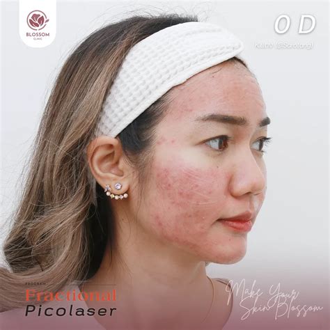Pico Laser คืออะไร ทำไมถึงยอดนิยม ลดกระ ฝ้า ที่ Blossomclinic