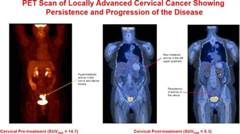 Positron Emission Tomography Scan Of Locally Advanced Cervix Cancer
