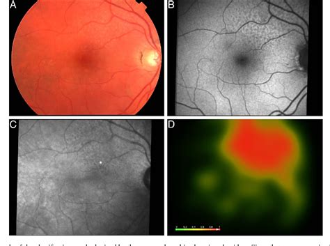 Figure 1 From Automatic Identification Of Reticular Pseudodrusen Using Multimodal Retinal Image