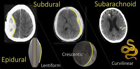 Subdural Hematoma Vs Subarachnoid Hemorrhage