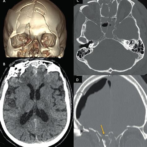 Cerebral Ct Scan At Patients Admission A 3d Reconstruction Of Download Scientific Diagram