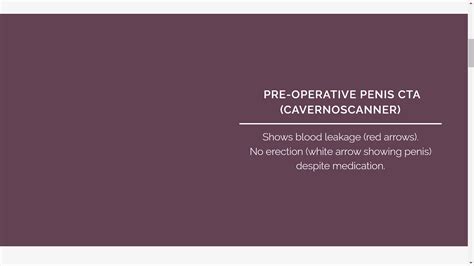 Venous Leak In Erectile Dysfunction Excel Male Trt Forum