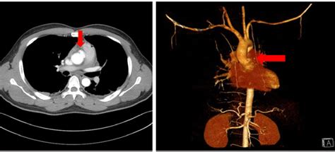 Computed Tomography Of Thoracic Aortography After 1 Day Pseudoaneurysm