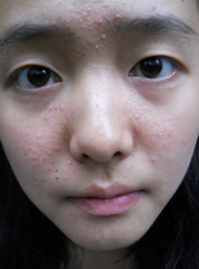 黑头粉刺怎么去除最好 4种方法还你平滑光洁皮肤 每日头条