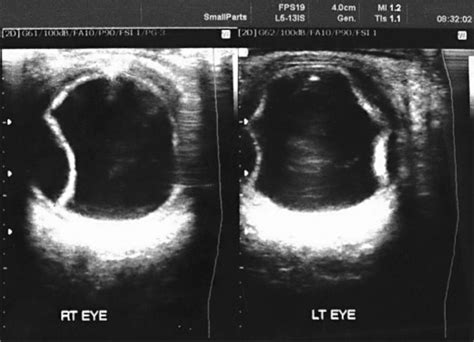 B Scan Ultrasonography Confirming Massive Choroidal Detachment In Both