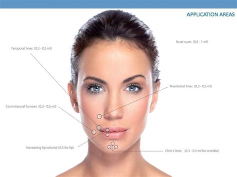 Dermalni Fileri Nyce