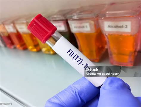 Fti 검사를위한 혈액 샘플 튜브 무료 티록신 지수 테스트 갑상샘기능 저하증에 대한 스톡 사진 및 기타 이미지 갑상샘기능