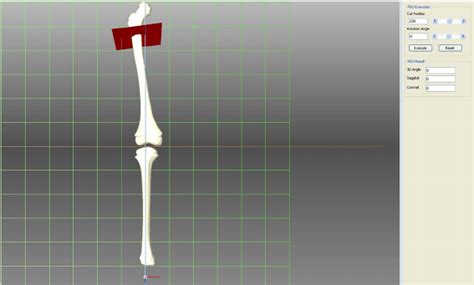 Three Dimensional Reconstruction Model Of Femoral Derotation Osteotomy