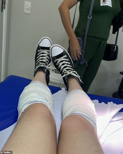 Taylor Swift Fans Say They Suffered Second Degree Burns At Brazilian