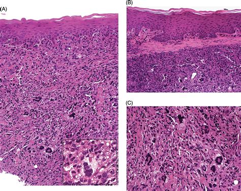 Juvenile Xanthogranuloma Histology