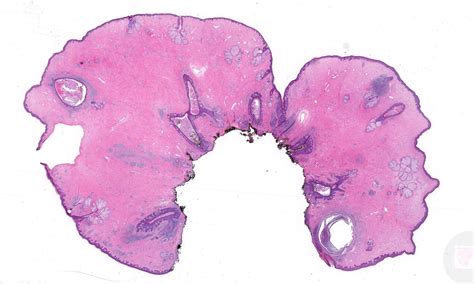 Jerad Gardner Md 75 Yo Man Erythematous Thickened Multinodular Skin