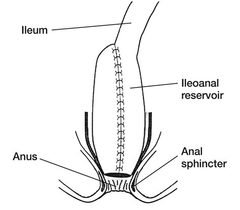 Ileoanal Pouch Anastomosis
