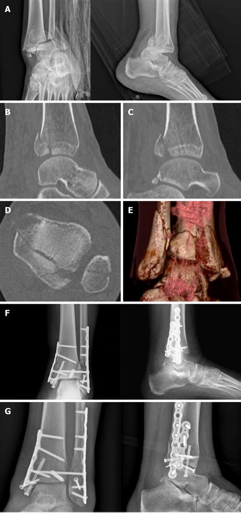 Fractured Tibia Ankle Ankle Fractures Orthosho