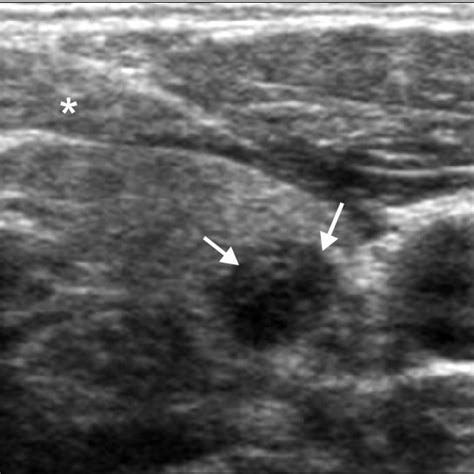 Thyroid Nodule With Taller Wider Dimensions Download Scientific Diagram