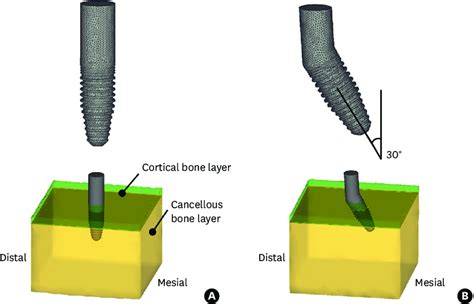 Finite Element Model Of The Implant Abutment And Artificial Bone Download Scientific Diagram