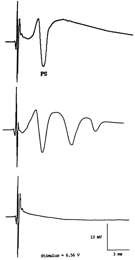 Representative Population Spike Responses A Top Normal Single Spike