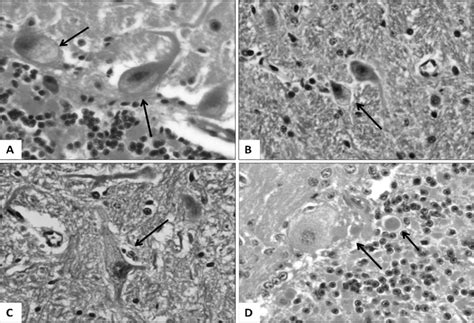 A Células De Purkinje Com Vacuolização Ina Do Pericário Do Cerebelo