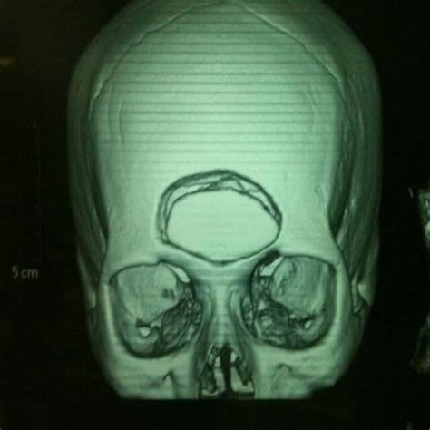 Bifrontal Craniotomy Fig 2 Frontolateral Craniotomy Download Scientific Diagram