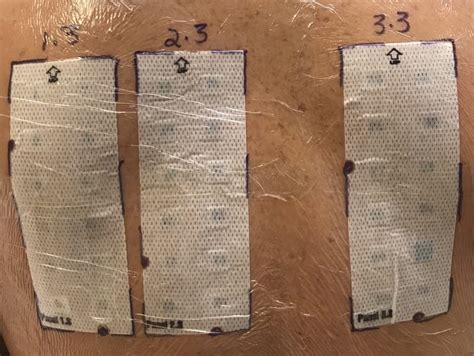 My Personal Story Of Allergic Contact Dermatitis Diagnosis And Acceptance Part Heather