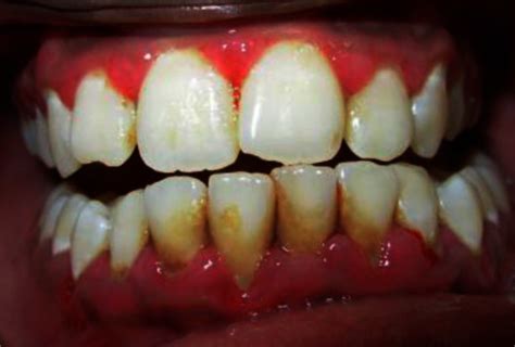 Intraoral Photograph At Initial Examination Showing Spontaneous
