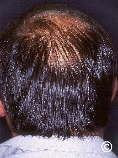 Male Pattern Alopecia Androgenetic Alopecia And Female Pattern Alopecia