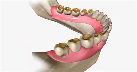 Premium Photo Dental Erosion Also Known As Tooth Erosion