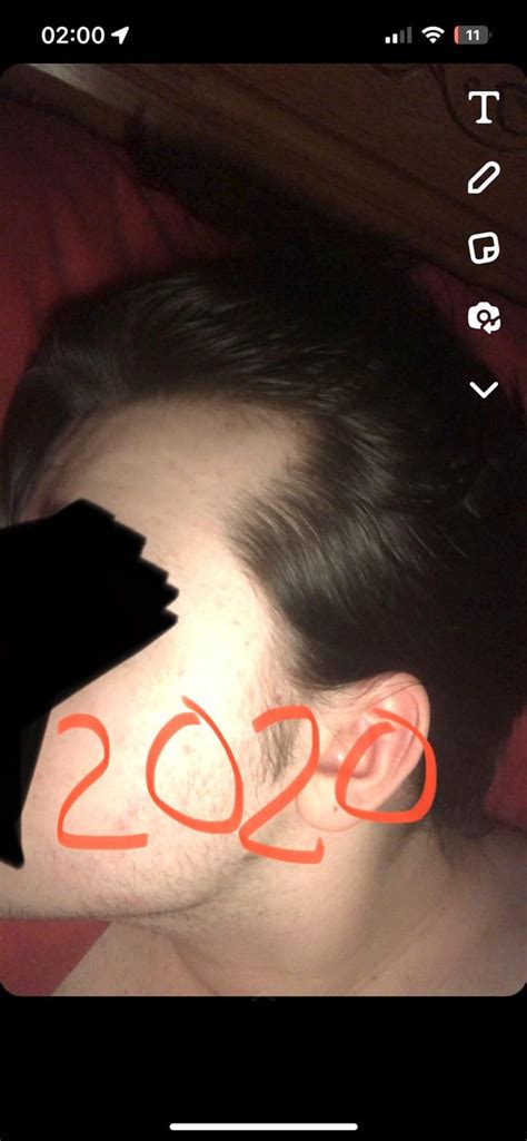 Hair Loss And Finasteride Progress 5 Years 2 Years Fin Rtressless