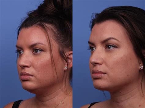 Submental Liposuction Before And After Photo Gallery Scottsdale