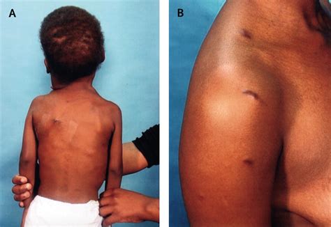 Swollen Lymph Nodes In Neck Hiv