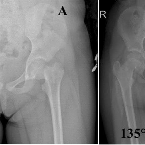 Demonstration Of Delbet Classification On X Ray Image Red Line