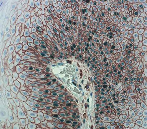 What Are The Differences Between Ihc And Ish And How Do They Help In The Fight Against Cancer