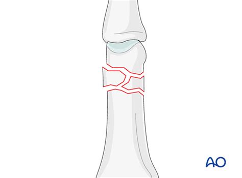Wedge Multifragmentary Extraarticular Fracture Of The Distal End Segment