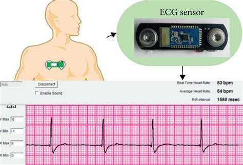 Process Of Ecg Signal Collection Ecg Electrocardiogram Download Scientific Diagram