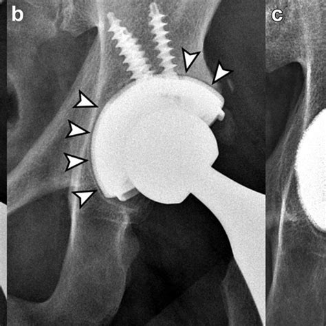 Pdf Early Aseptic Loosening Of The Tritanium Primary Acetabular Component With Screw Fixation