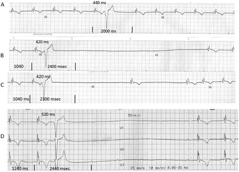 Intermittent Atrioventricular Block What Is The Mechanism Heart Rhythm