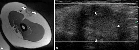 A 67 Year Old Woman With Palpable Mass And Skin Dimpling To The Lateral