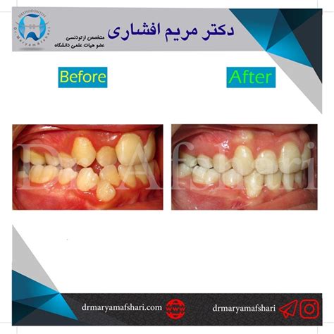نمونه درمان ارتودنسی دكتر مريم افشاری متخصص ارتودنسي در خرم آباد و کرج
