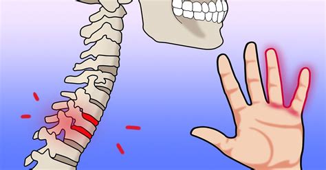 Cómo Saber Si Tengo Deficiencia De Vitamina B12 Salud180
